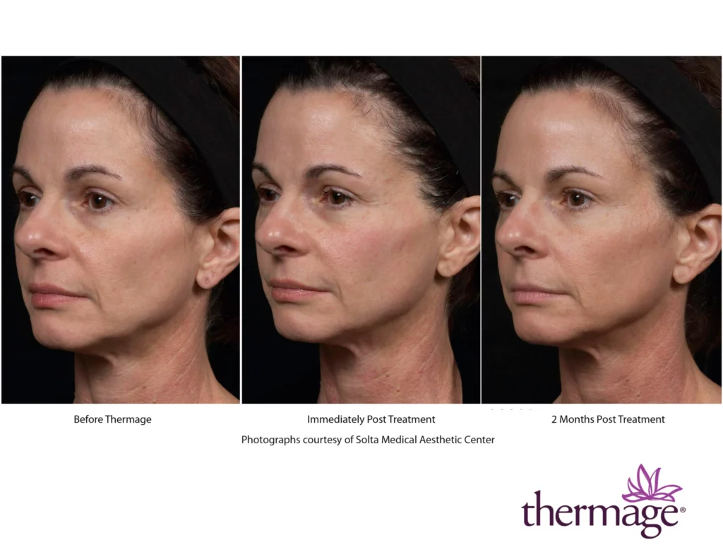 How Long Do Thermage Results Last? | Radiance Skincare & Laser Medspa