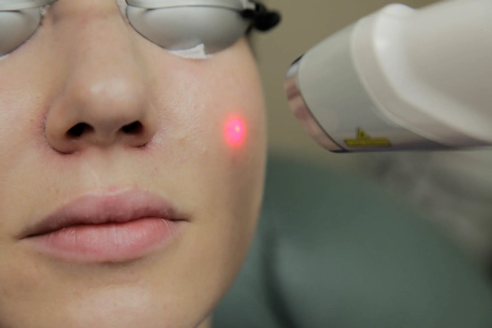 Laser Genesis in Wheaton, IL | Radiance Skincare & Laser Medspa
